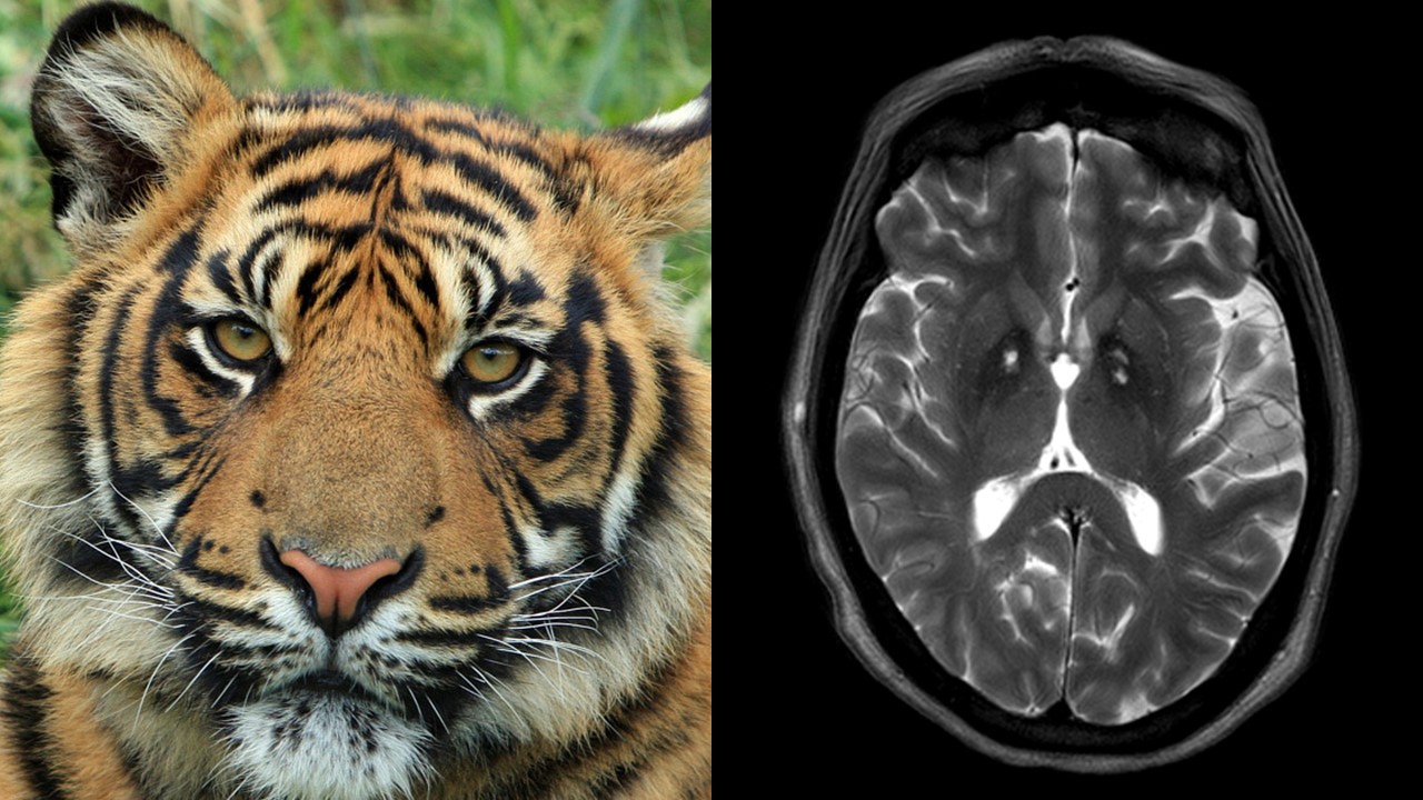泛酸激酶相关神经变性 (PKAN)--虎眼征-中国医学影像联盟-China Medical Imaging Association
